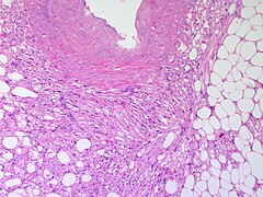 Angiomyolipoma - Libre Pathology
