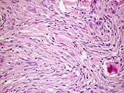 Meningioma - Libre Pathology