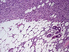 Dermatofibrosarcoma protuberans - Libre Pathology