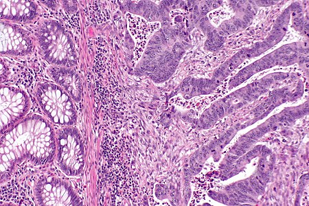 Colorectal adenocarcinoma - Libre Pathology