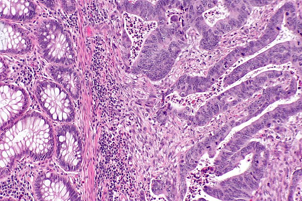 Colorectal adenocarcinoma - Libre Pathology
