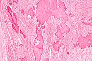 Ovarian fibroma - Libre Pathology