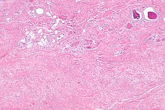 Elastofibroma - Libre Pathology