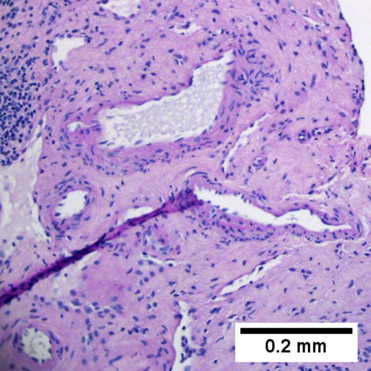 Focal nodular hyperplasia - Libre Pathology
