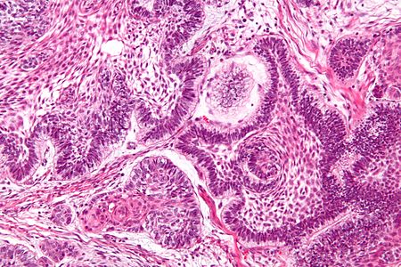 Ameloblastoma - Libre Pathology
