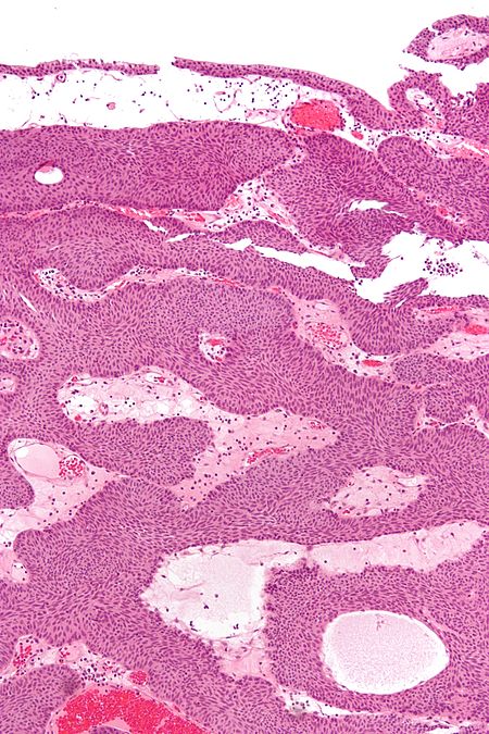 Inverted urothelial papilloma - Libre Pathology