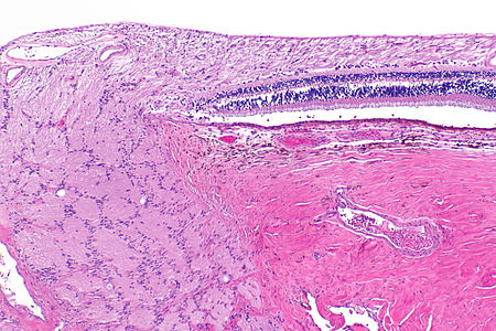 Eye - Libre Pathology