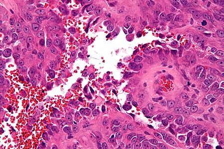 Angiosarcoma - Libre Pathology