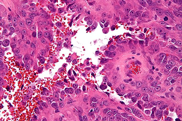 Angiosarcoma - Libre Pathology