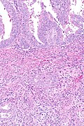Microcystic elongated and fragmented glands in endometrioid endometrial ...