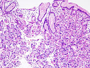 Fundic gland polyp - Libre Pathology