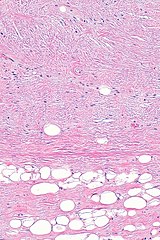 Spindle cell lipoma - Libre Pathology