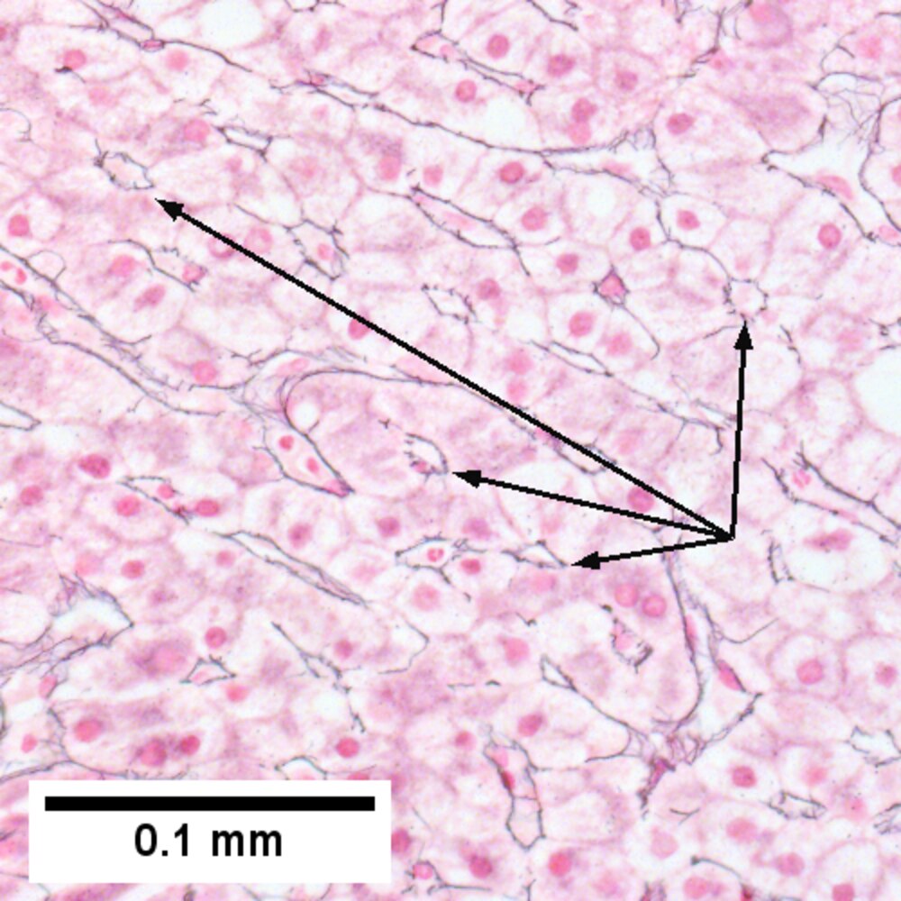 Steatohepatitis - Libre Pathology