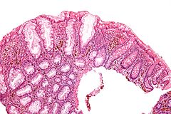 Pseudomelanosis coli - Libre Pathology