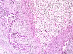 Phyllodes tumour - Libre Pathology