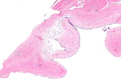 Ganglion cyst - Libre Pathology