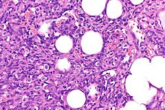 Angiosarcoma - Libre Pathology