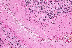 Neuropathology - Libre Pathology