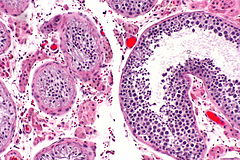 Testicular atrophy - Libre Pathology