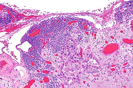 Pleural invasion - Libre Pathology