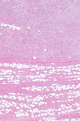 Spindle cell lipoma - Libre Pathology