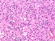 Malakoplakia - Libre Pathology