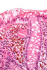 Pseudomelanosis coli - Libre Pathology
