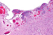 Pleural invasion - Libre Pathology