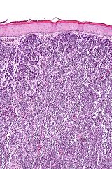 Merkel cell carcinoma - Libre Pathology