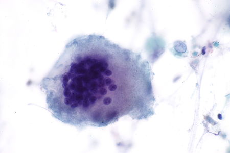 Giant cells - Libre Pathology