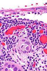 Pleural invasion - Libre Pathology