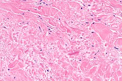 Elastofibroma - Libre Pathology