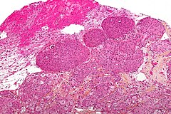 Meningioma - Libre Pathology