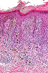 Pigmented spindle cell nevus - Libre Pathology