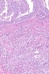 Microcystic elongated and fragmented glands in endometrioid endometrial ...