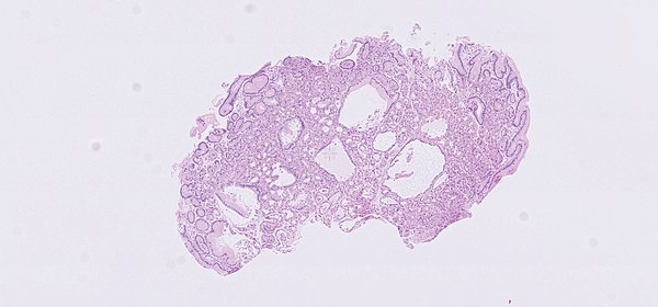 Fundic gland polyp - Libre Pathology
