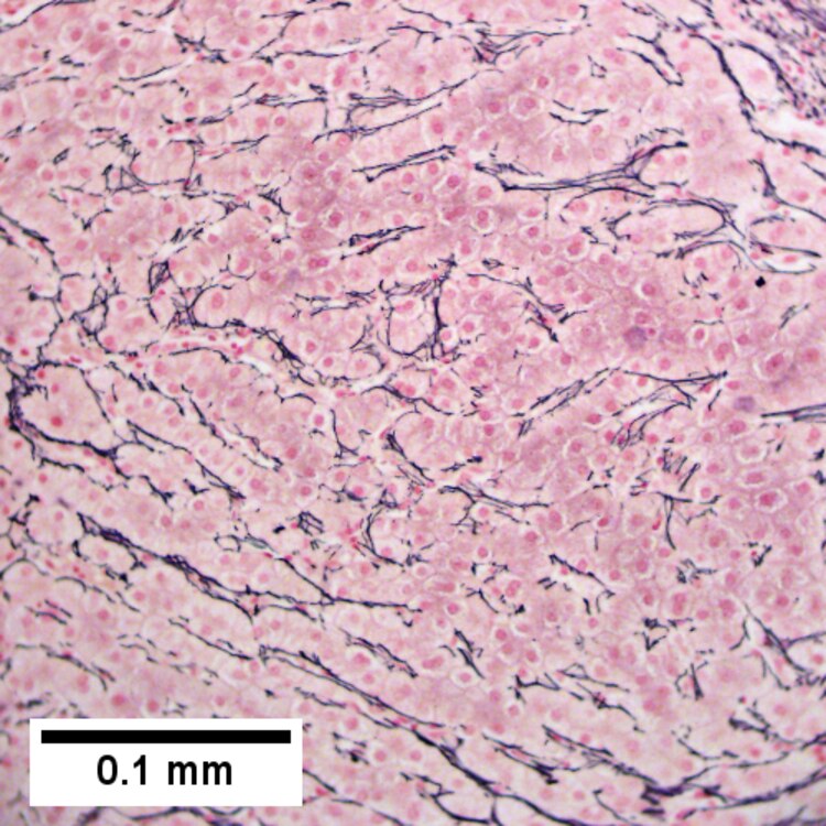 Focal nodular hyperplasia - Libre Pathology