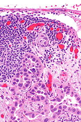 Pleural invasion - Libre Pathology