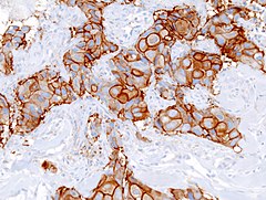 Invasive ductal carcinoma of the breast - Libre Pathology