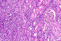 Angiosarcoma - Libre Pathology