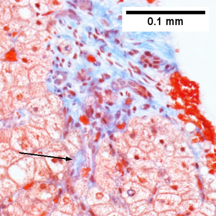 Steatohepatitis - Libre Pathology