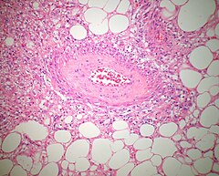 Angiomyolipoma - Libre Pathology