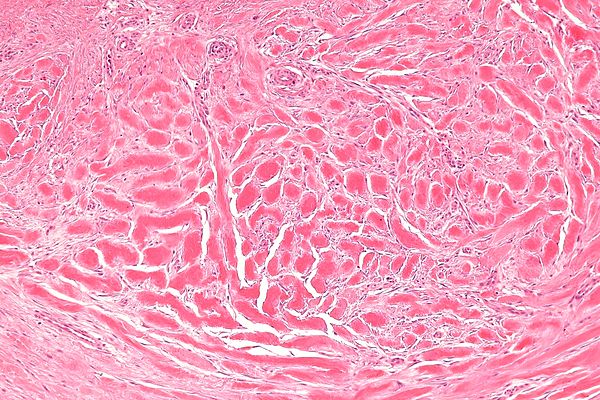 Keloid - Libre Pathology