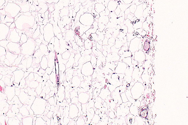 Lipoma - Libre Pathology