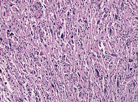 High-grade astrocytoma with piloid features - Libre Pathology